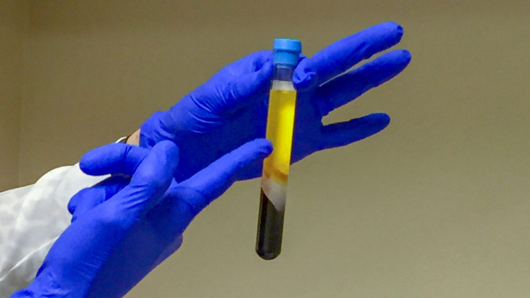 What is PRP and Why Does it Work? - Plastic Surgery One